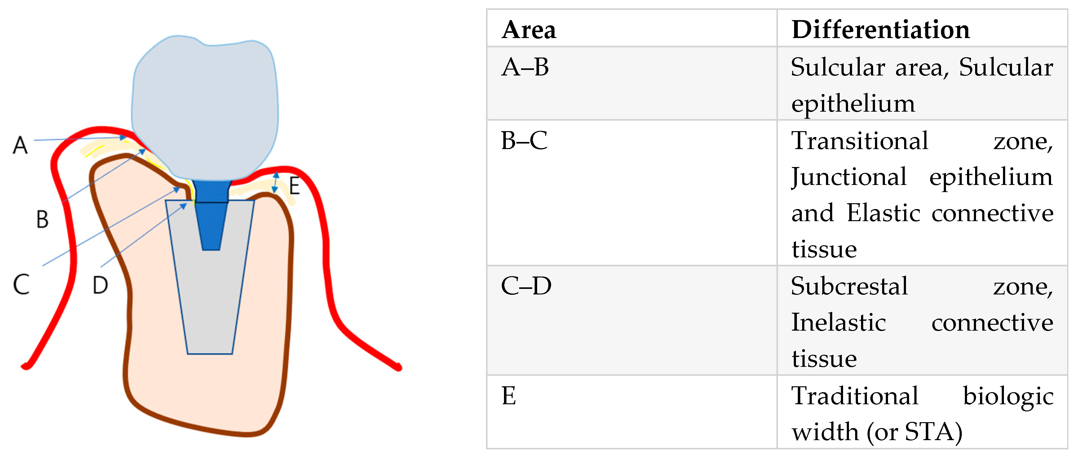 A Novel Framework for Optimizing Peri-Implant Soft Tissue in ...