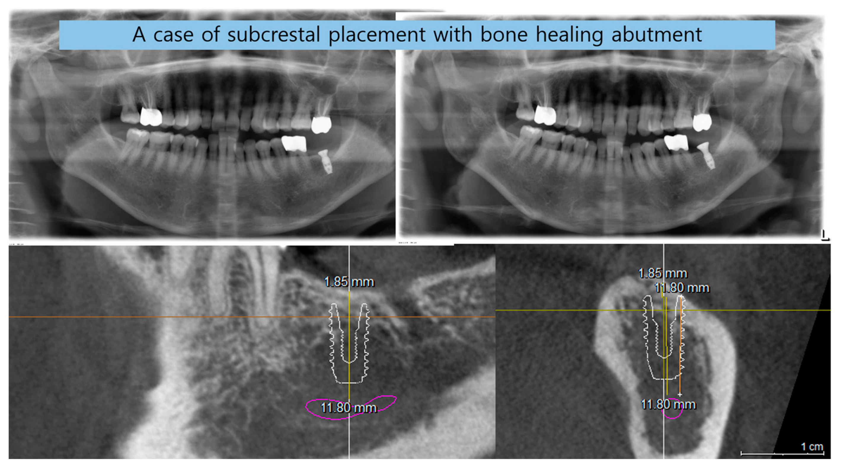 A Novel Framework for Optimizing Peri-Implant Soft Tissue in ...