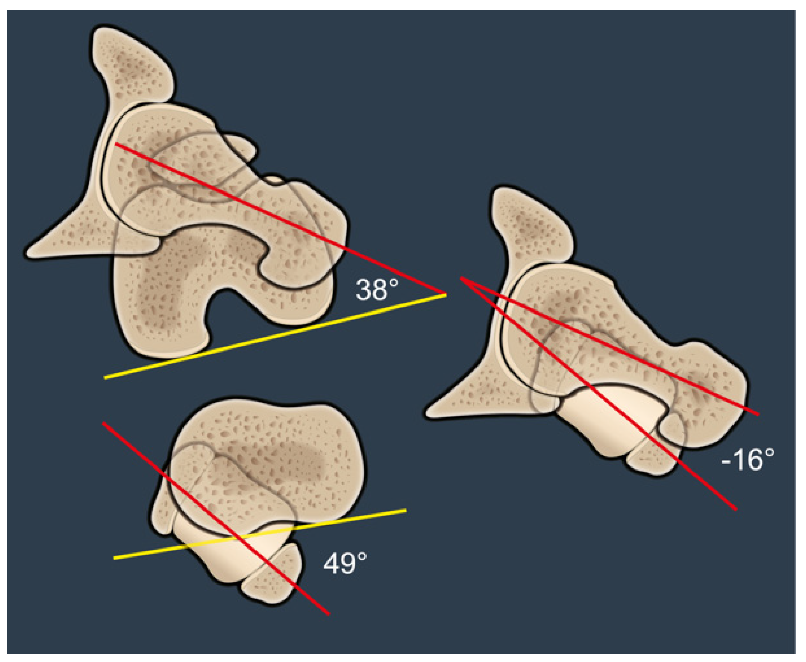 The Effect of Overall Limb Torsion on Functional Femoral Version and ...