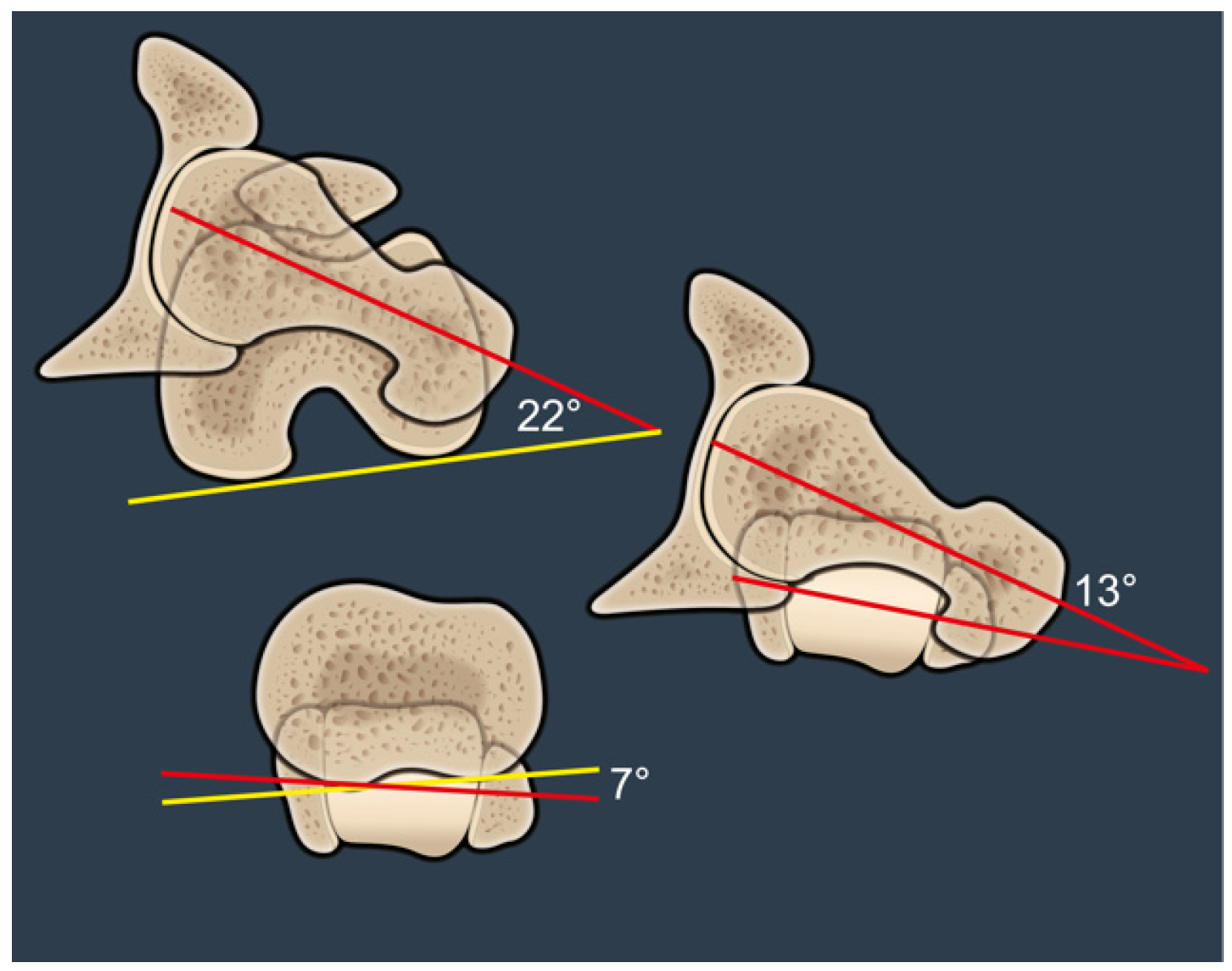 The Effect of Overall Limb Torsion on Functional Femoral Version and ...