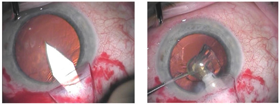 Ten-Year Results After Canaloplasty and Phacocanaloplasty