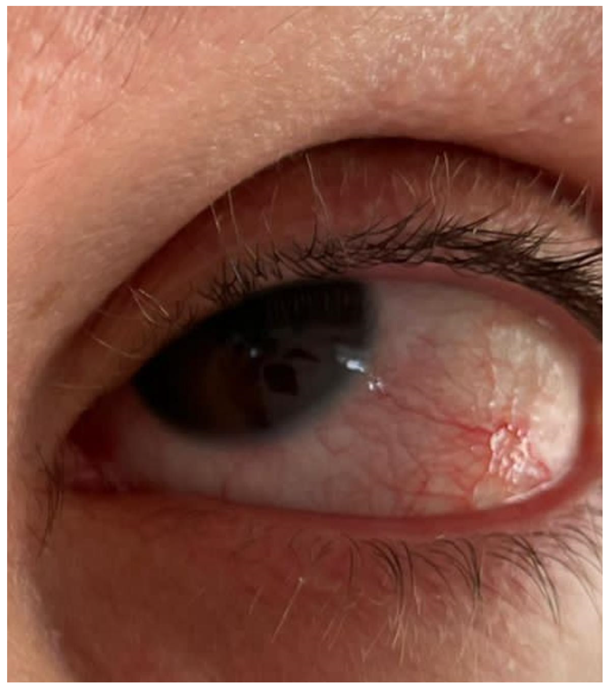 Ocular Side Effects of Dupilumab: A Comprehensive Overview of the ...