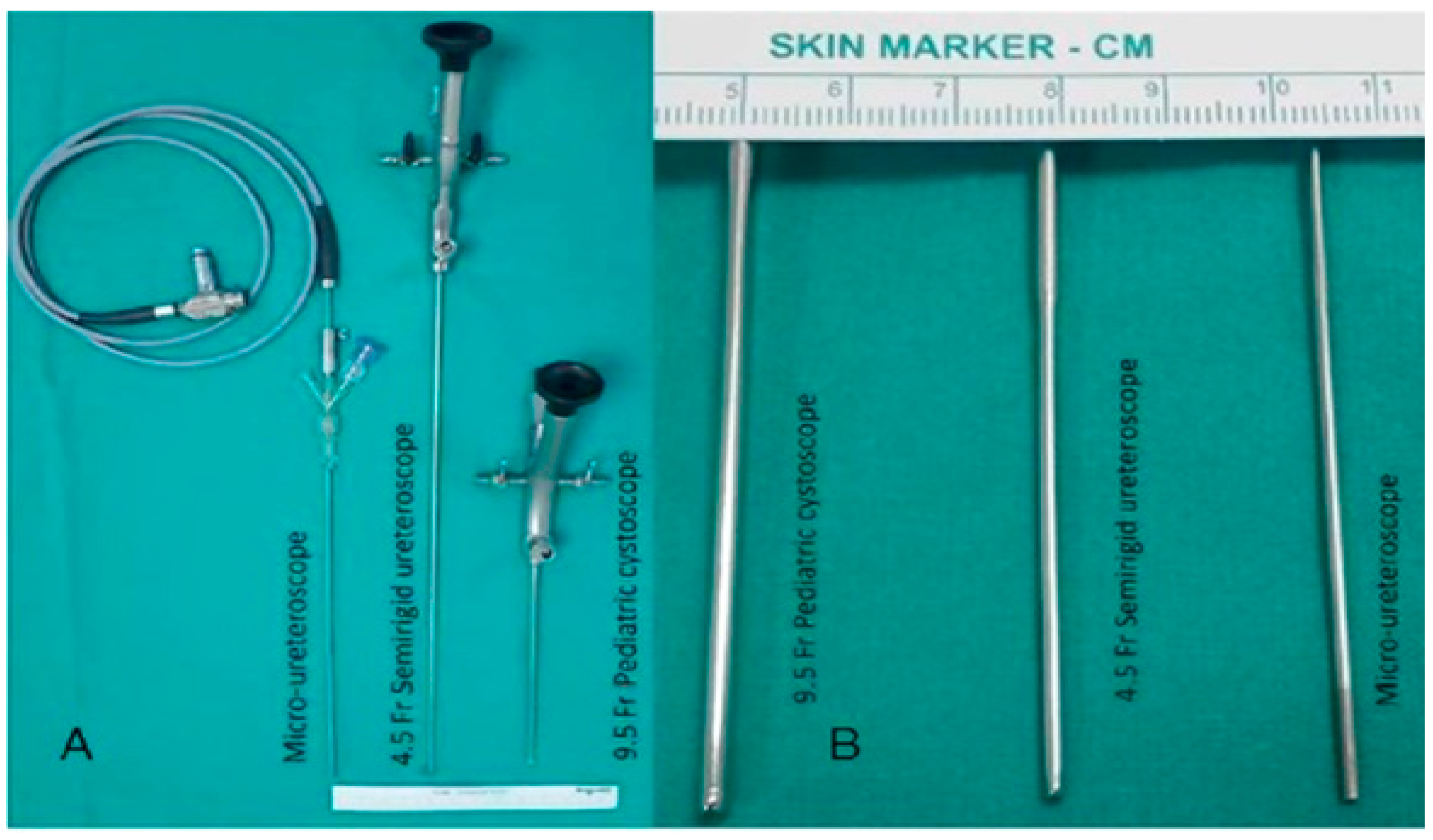 Micro-URS Experience in the Treatment of Distal Ureteral Stones in ...
