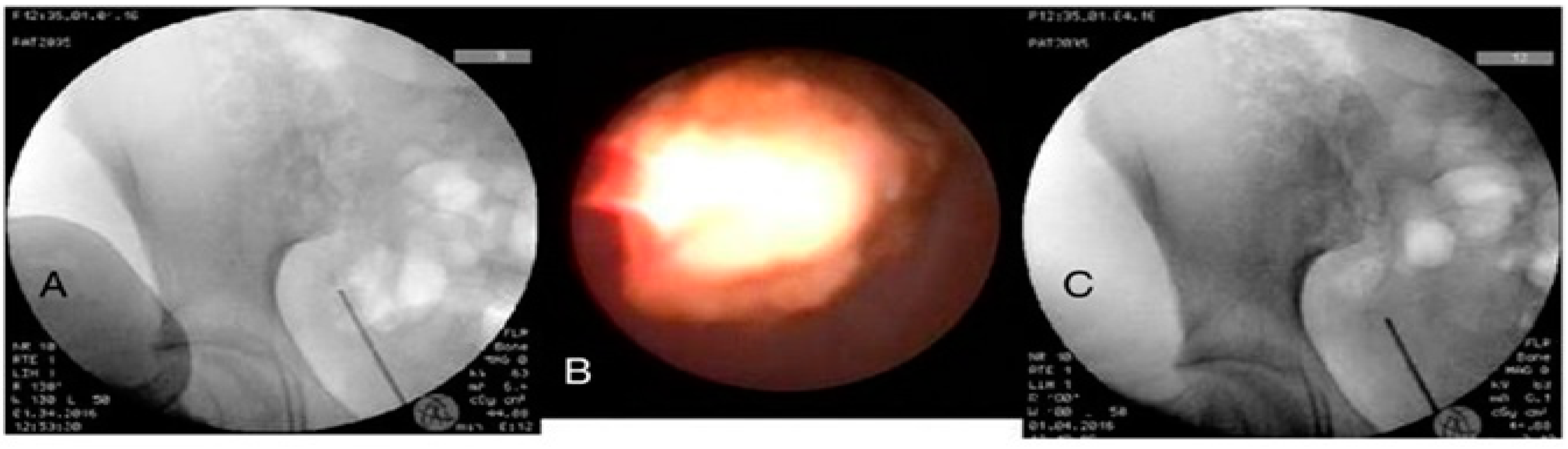 Micro-URS Experience in the Treatment of Distal Ureteral Stones in ...