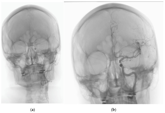Carotid Web as a Cause of Ischemic Stroke: Effective Treatment with ...