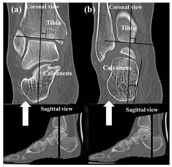 Weightbearing Computed Tomography (WBCT) Analysis of Subtalar Joint ...