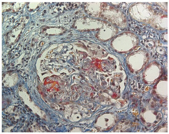 The Recurrence of Systemic Diseases in Kidney Transplantation