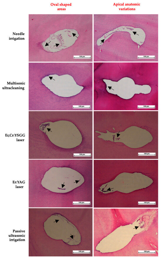 Multisonic Ultracleaning and Laser-Activated Irrigation Effect Compared ...