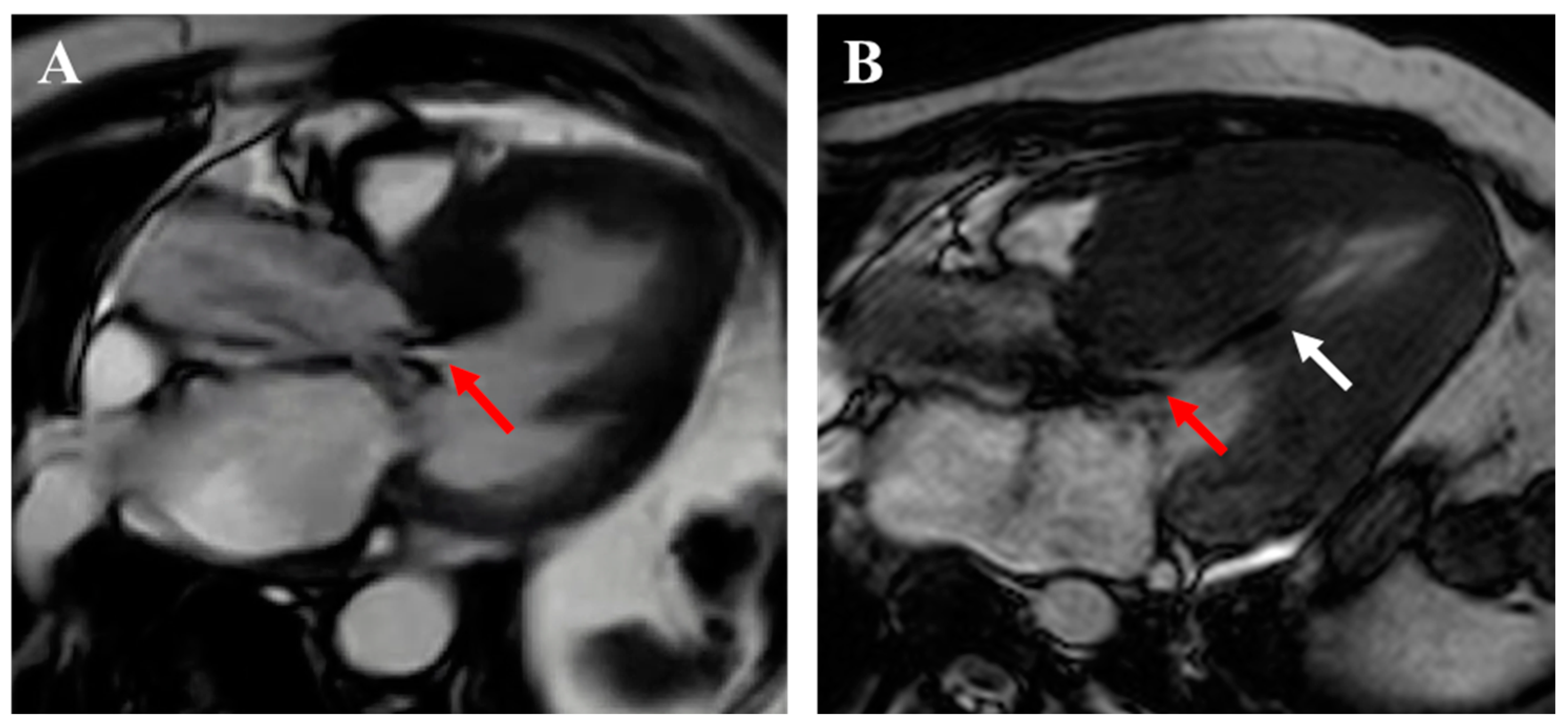 A Practical Approach to Multimodality Imaging in Hypertrophic ...