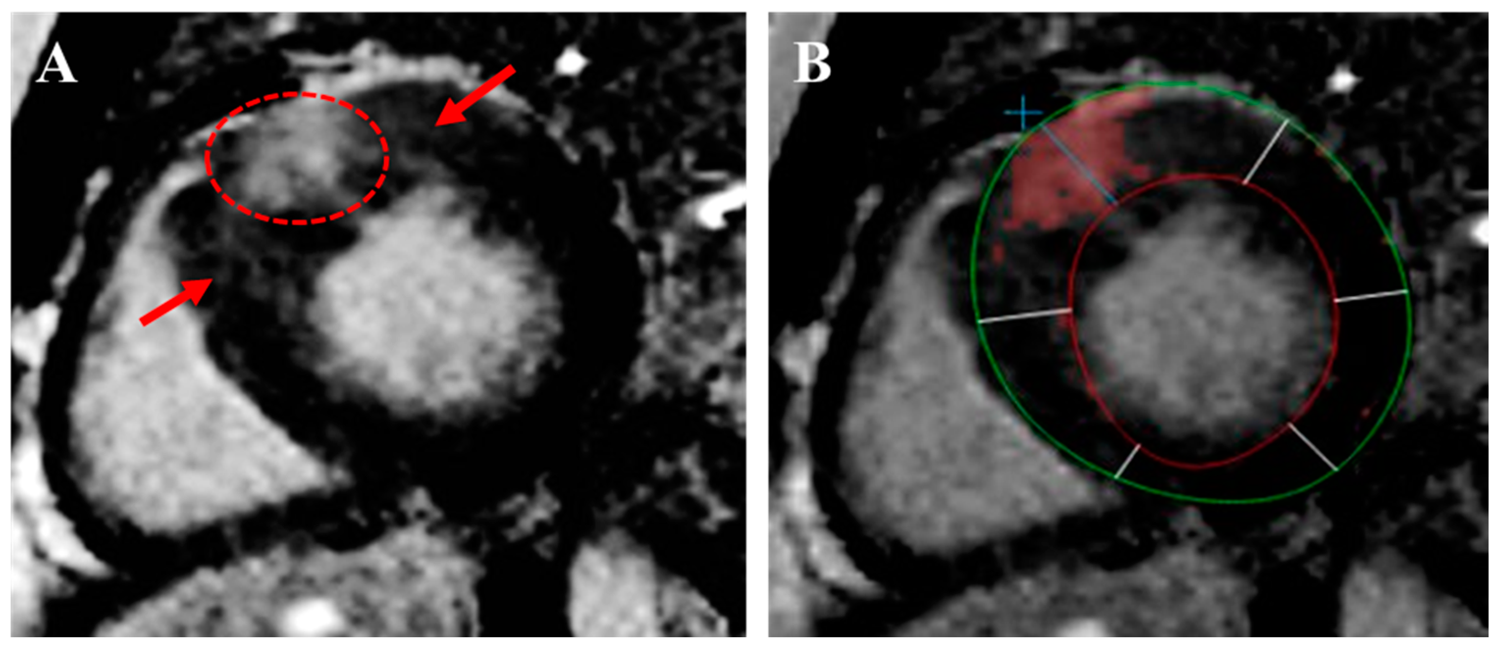 A Practical Approach to Multimodality Imaging in Hypertrophic ...