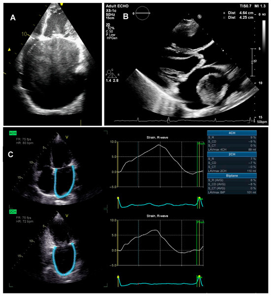 Upstream and Downstream Cardiovascular Changes in Rheumatic Mitral ...