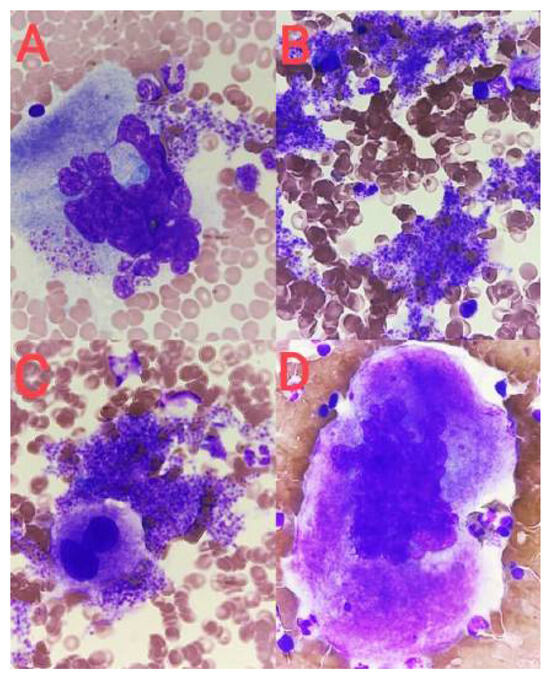 The Role of Megakaryocyte Assessment in Bone Marrow Cytology