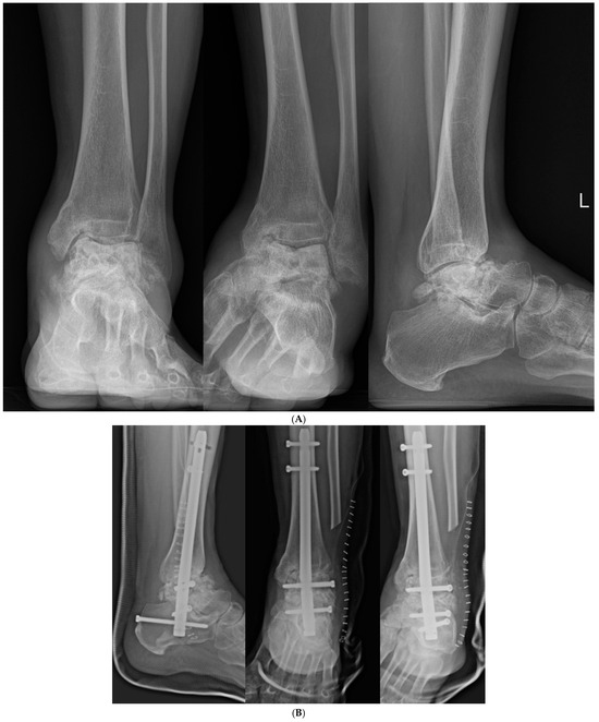 Talar Allografts in Tibiotalocalcaneal Arthrodesis: A Salvage Approach ...