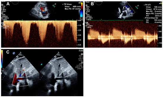 Echocardiography-Based Pulmonary Artery Pulsatility Index Correlates ...