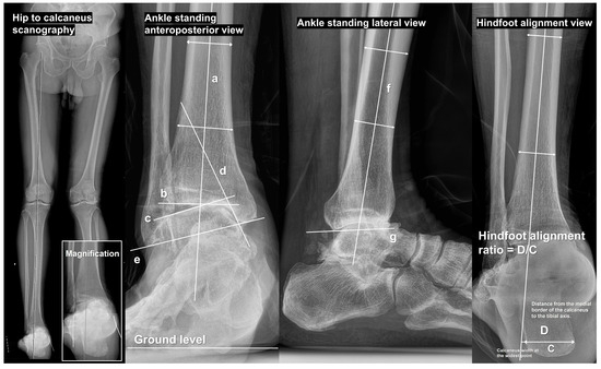 Surgical Correction of Large Talar Tilt in Varus Ankle Osteoarthritis ...