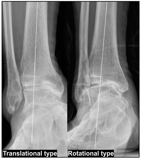 Surgical Correction of Large Talar Tilt in Varus Ankle Osteoarthritis ...