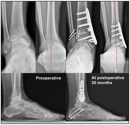 Surgical Correction of Large Talar Tilt in Varus Ankle Osteoarthritis ...