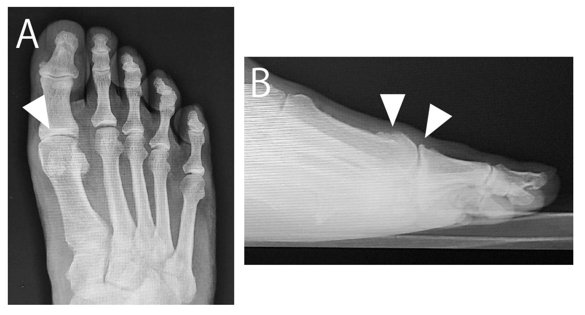 Arthroscopic Flexor Hallux Brevis and Plantar Capsule Release (Cochrane ...