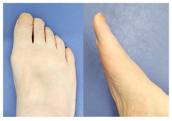 Arthroscopic Flexor Hallux Brevis and Plantar Capsule Release (Cochrane ...