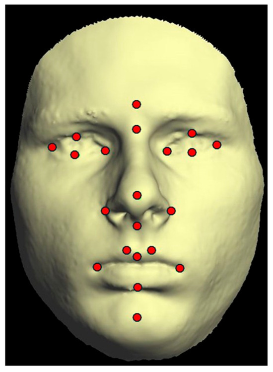 Changes in Facial Soft Tissue Asymmetry in Class II Patients One Year ...