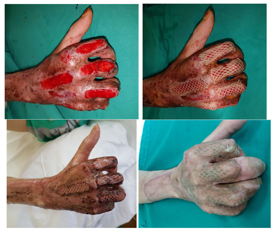 The Use of Integra Dermal Regeneration Template in Exposed Bone ...