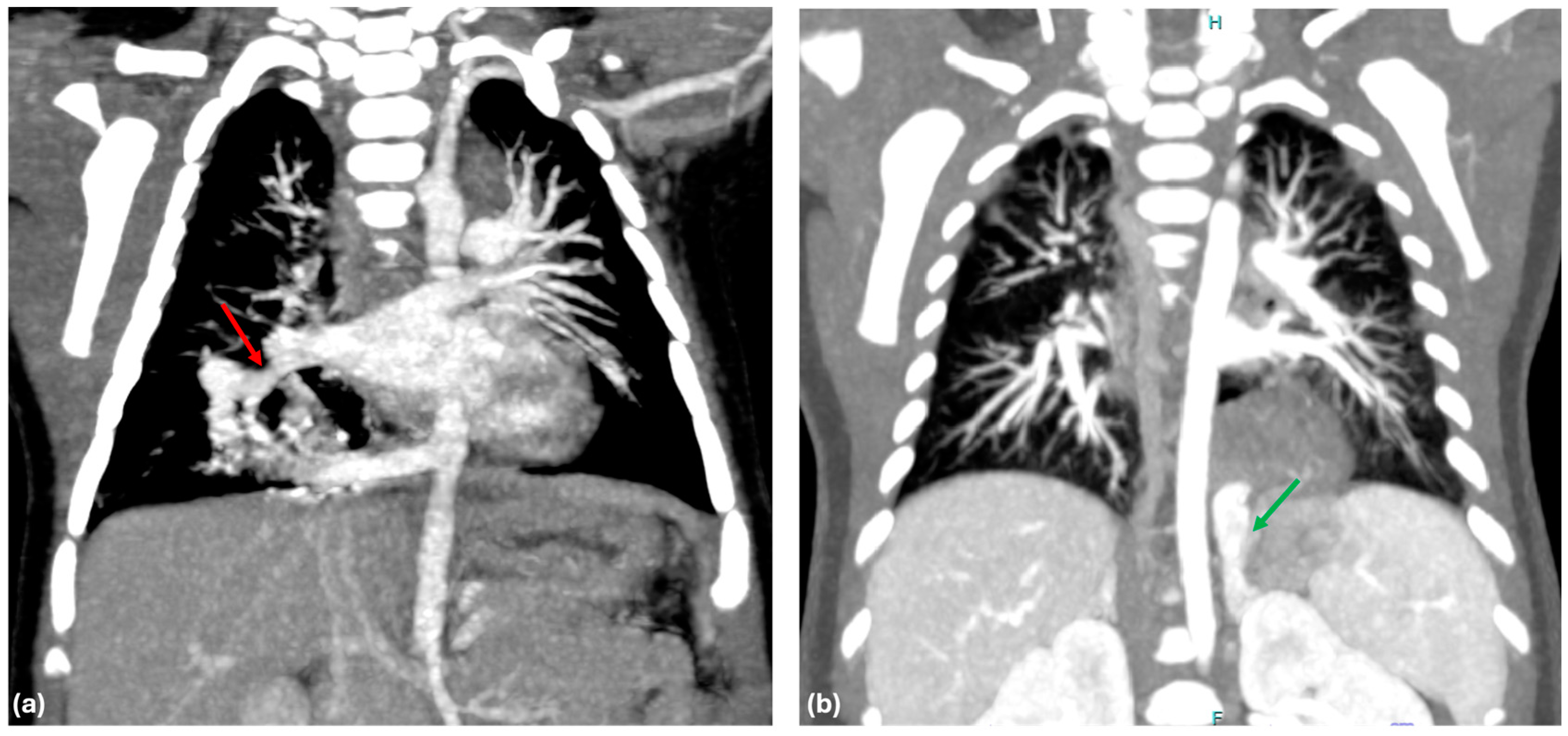 Predictive Role of Venous Drainage and Lesion Margins in ...