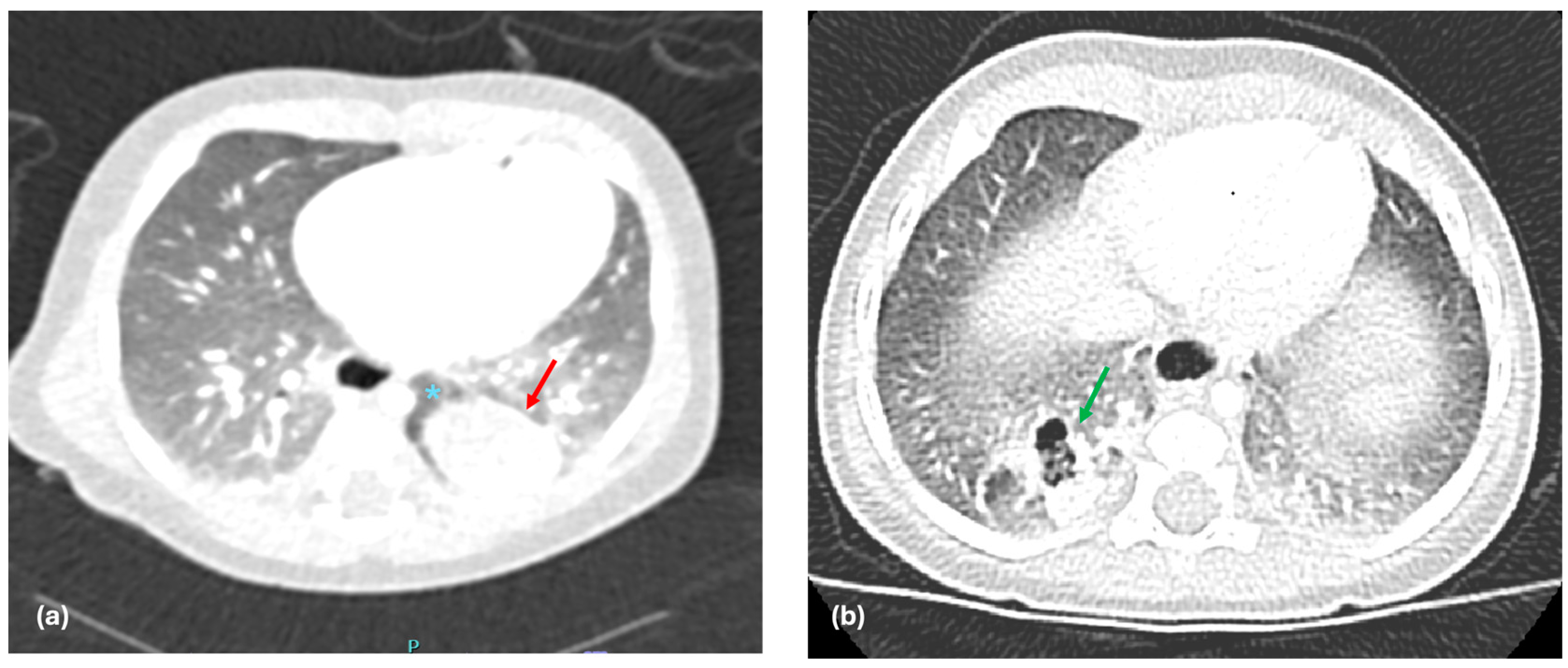 Predictive Role of Venous Drainage and Lesion Margins in ...