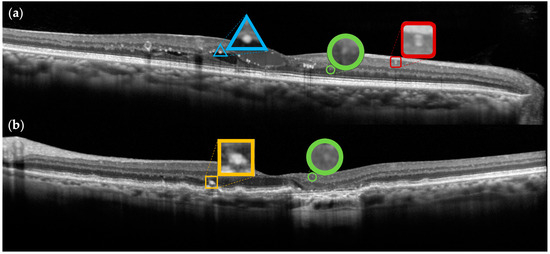 Hyperreflective Retinal Foci (HRF): Definition and Role of an ...