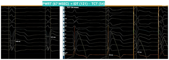 Understanding LOT-CRT: Current Insights, Limitations, and Our Center’s ...