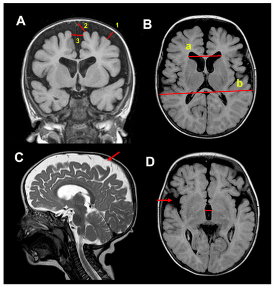 Continuous Intracranial Pressure Monitoring in Children with ‘Benign ...