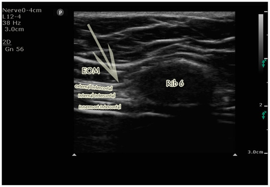 A Comparison of Two Fascial Plane Blocks for Abdominal Analgesia in ...