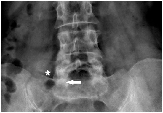 New Technique for S1 Nerve Root Transforaminal Percutaneous ...