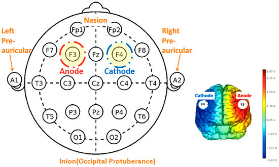 Transcranial Direct Current Stimulation (tDCS) in the Treatment of ...