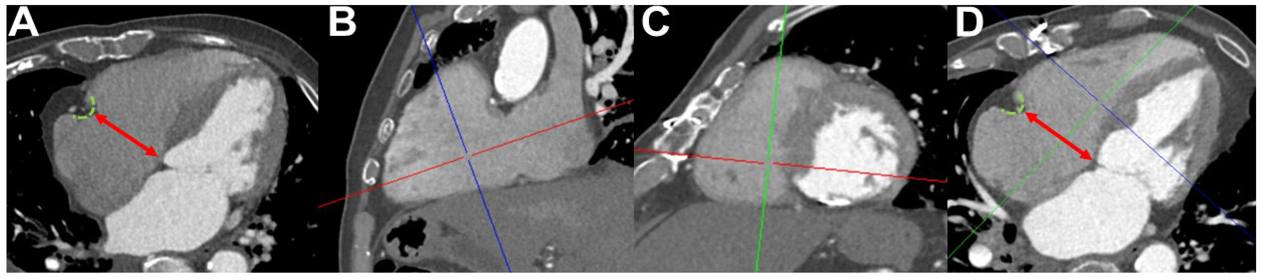 The Prognostic Value of Tricuspid Annular Dimensions in TAVI Patients ...