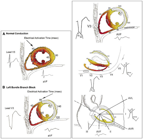 Cardiac Resynchronization Therapy and Conduction System Pacing