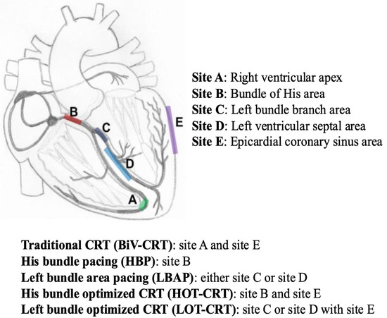 Cardiac Resynchronization Therapy and Conduction System Pacing
