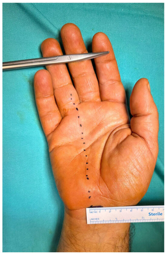 Directly Visualized Carpal Tunnel Release via a Proximal Mini ...
