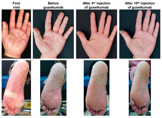 Emerging Therapies for Palmoplantar Pustulosis with a Focus on IL-23 ...