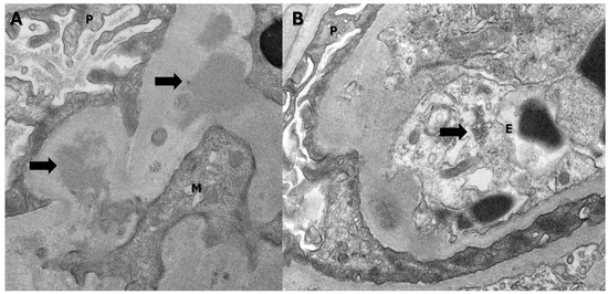 Crescentic Glomerulonephritis Possibly Caused by COVID-19 Infection