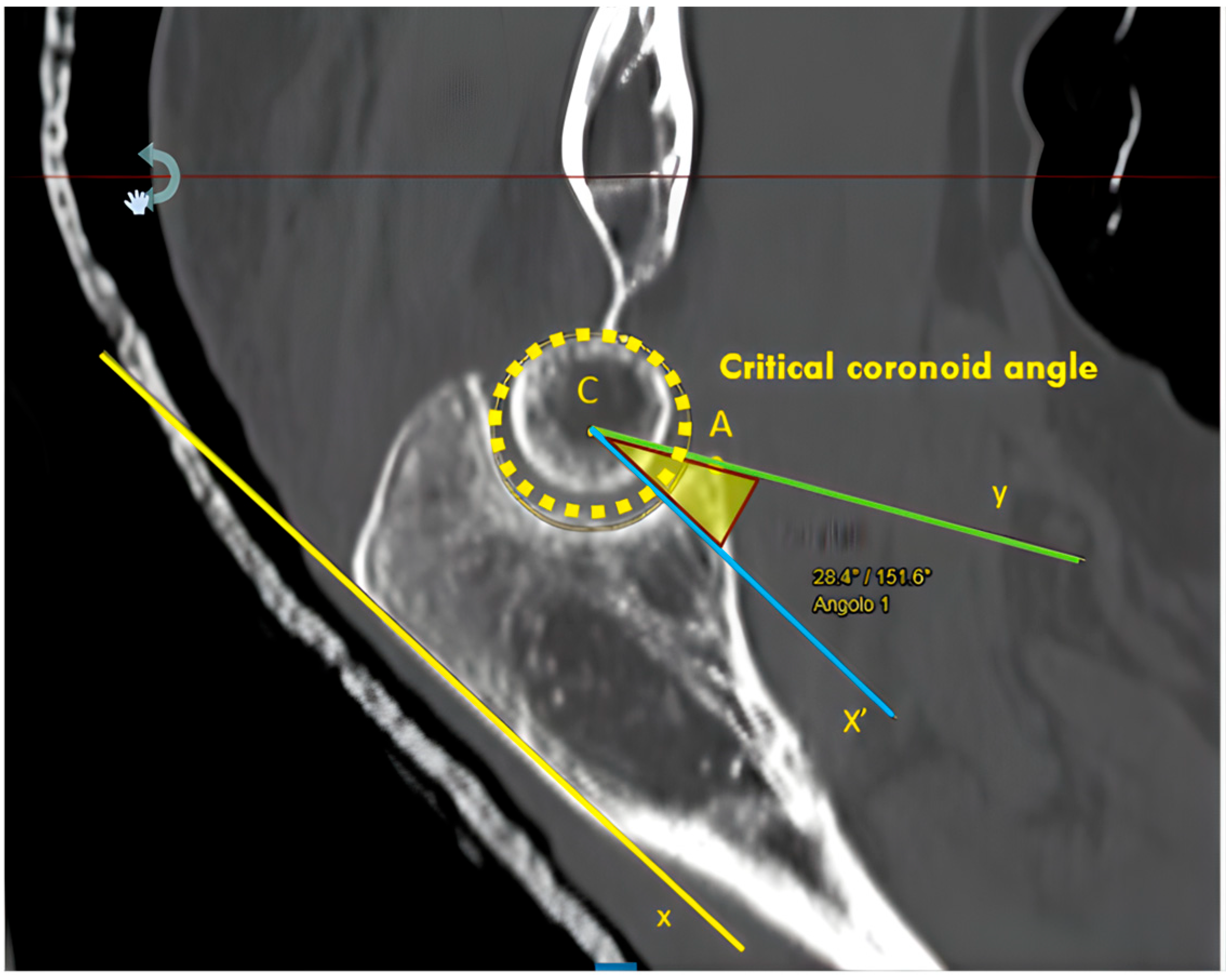 The Role of the Critical Coronoid Angle in Simple Elbow Dislocation: A ...