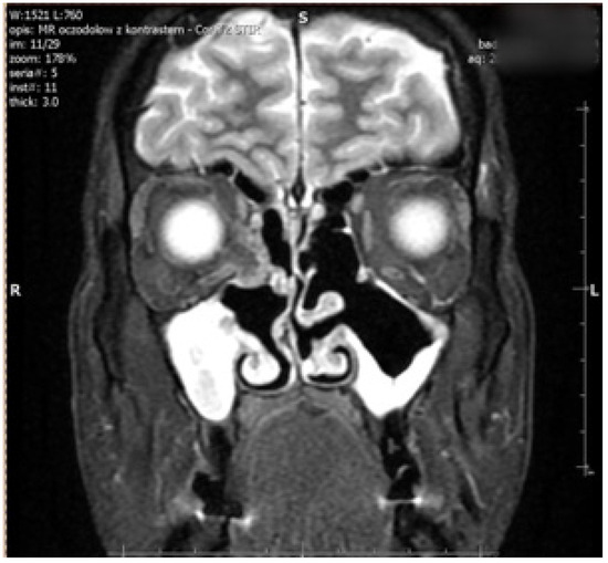Management of Mechanical Strabismus After Complicated Functional ...