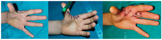 First Web Space Reconstruction in Acquired Defects: A Literature-Based ...