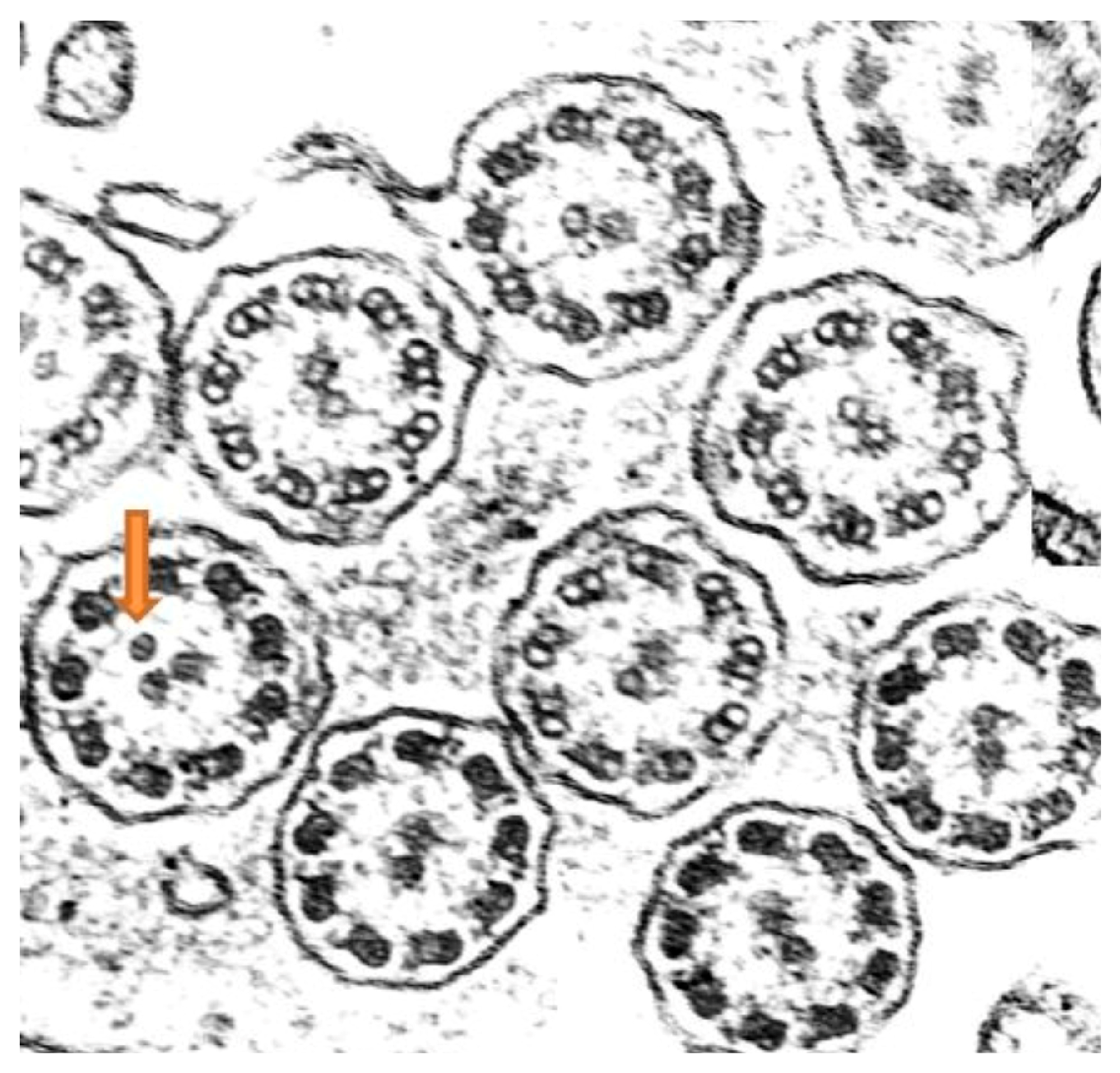 Ciliary Motility and Ultrastructure in Bronchial Epithelium of Lung ...