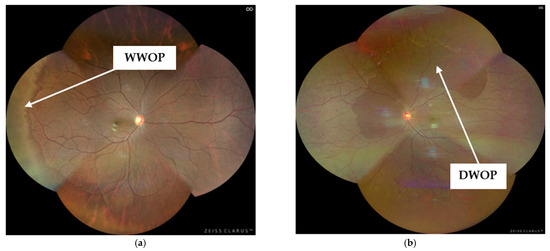 Exploring the Risk: Peripheral Retinal Degenerations in Young ...