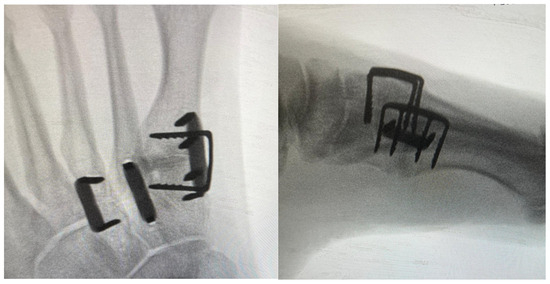 Continuous Compression Implants in Foot and Ankle Surgery: Tips and Tricks