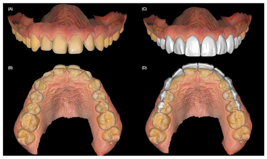 Accuracy of Digital Impressions for Veneer Restorations: A Narrative ...