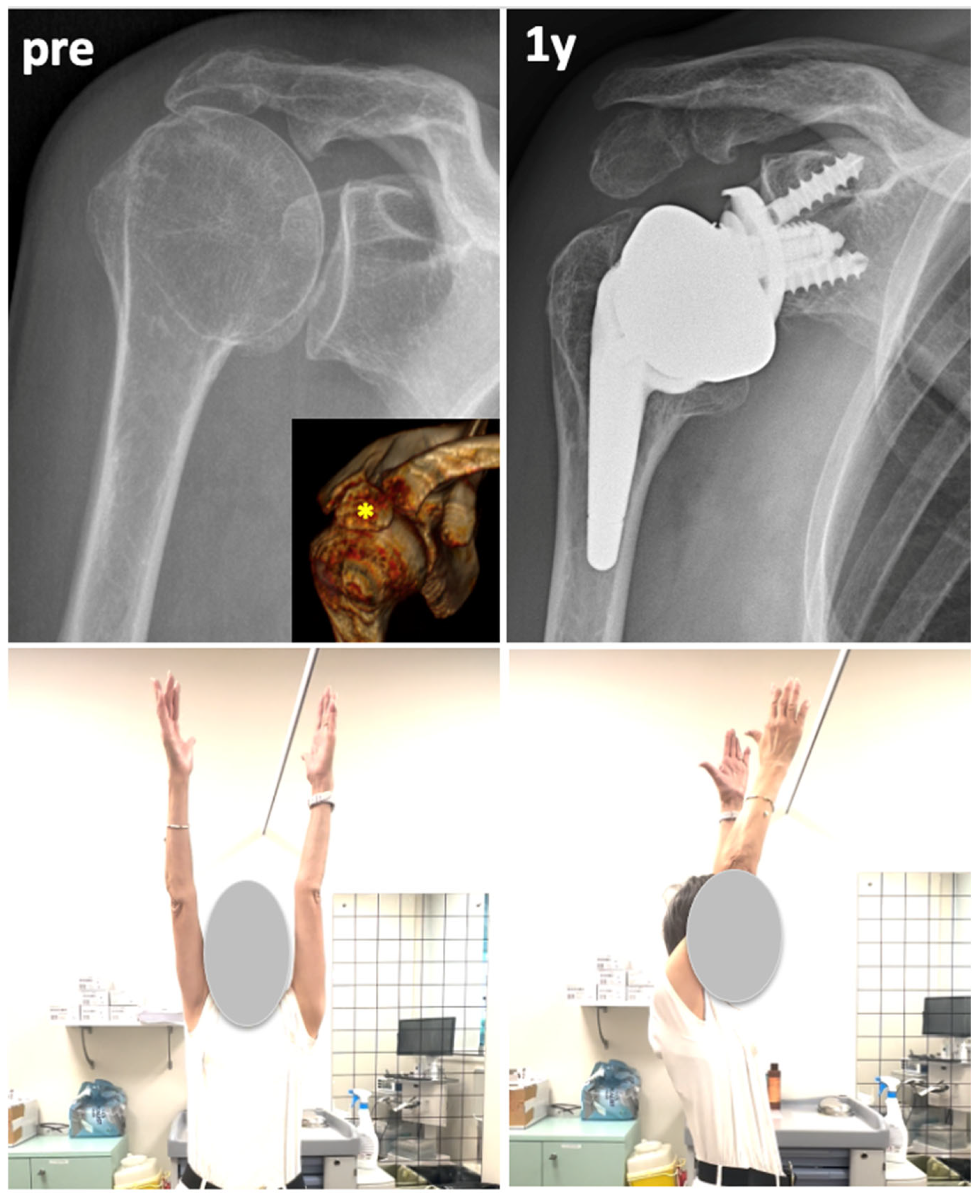 Reverse Total Shoulder Arthroplasty in Patients with Os Acromiale: A ...