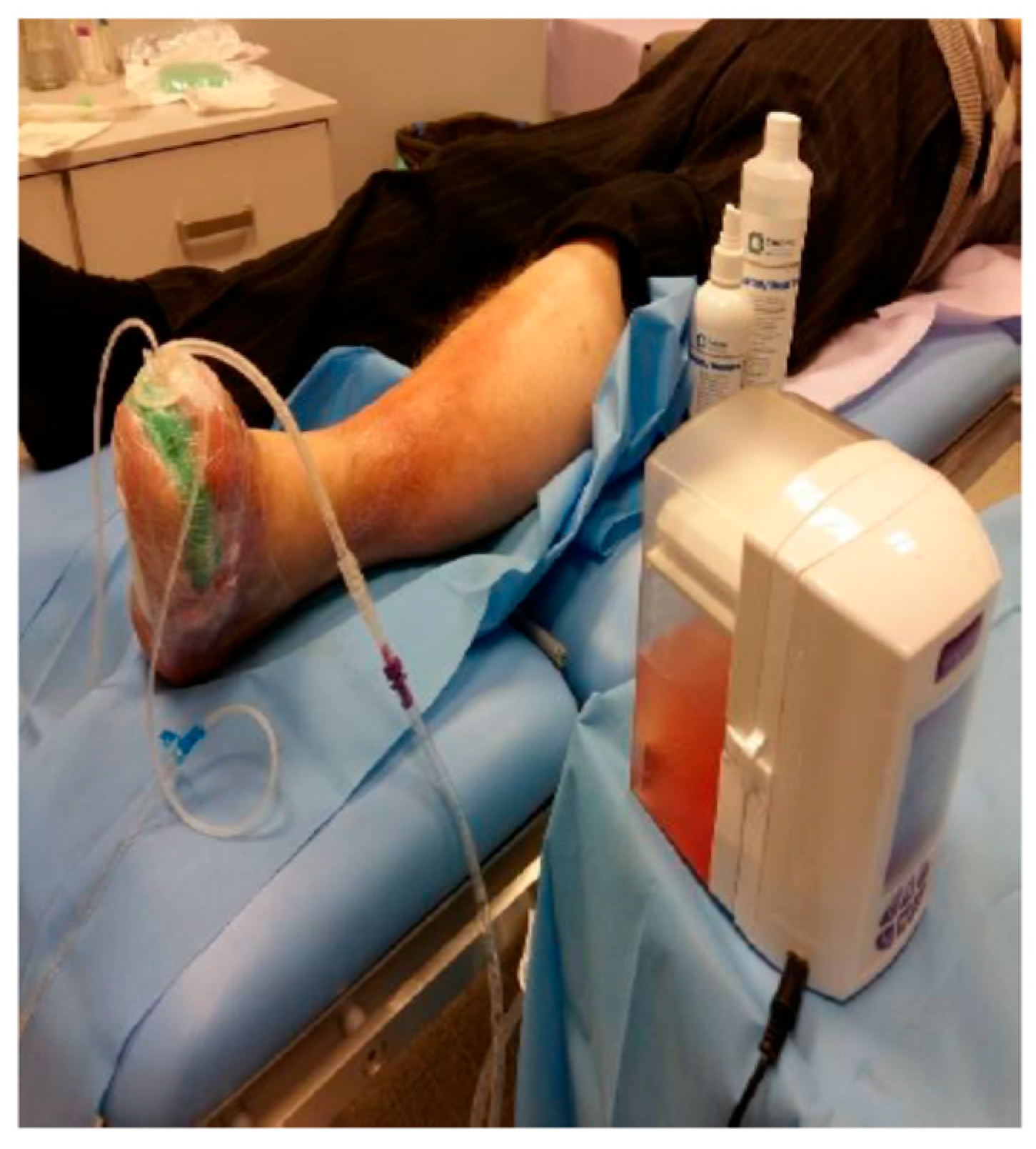 Ozone Therapy and Negative Pressure Wound Therapy in the Treatment of Difficult-to-Heal Wounds ...