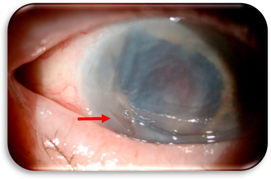 Corneal Perforation as a Possible Ocular Adverse Event Caused by ...
