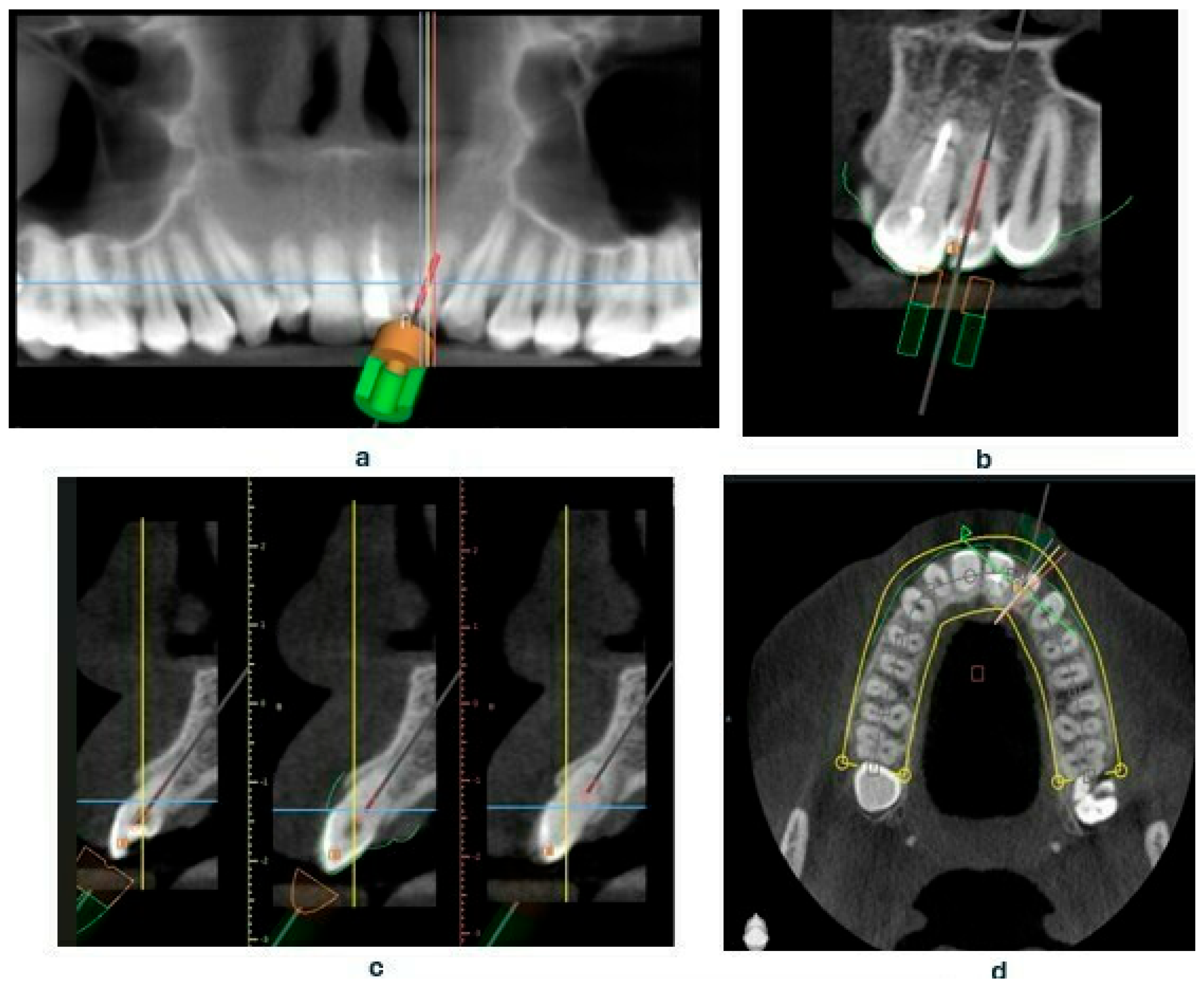 Guided Endodontics for a Tooth with Root Fracture: A Case Report
